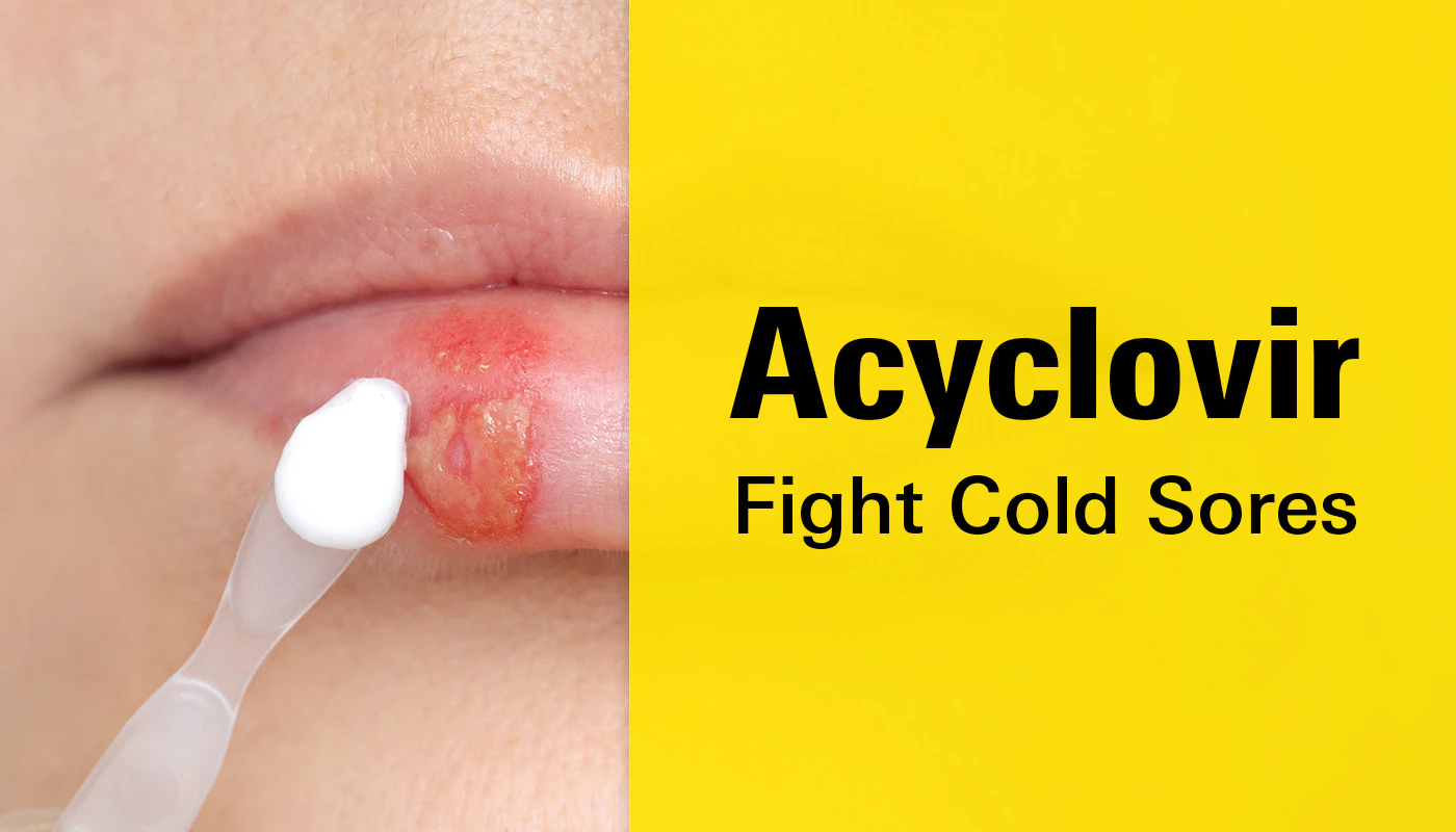 Acyclovir for Cold Sore Treatment