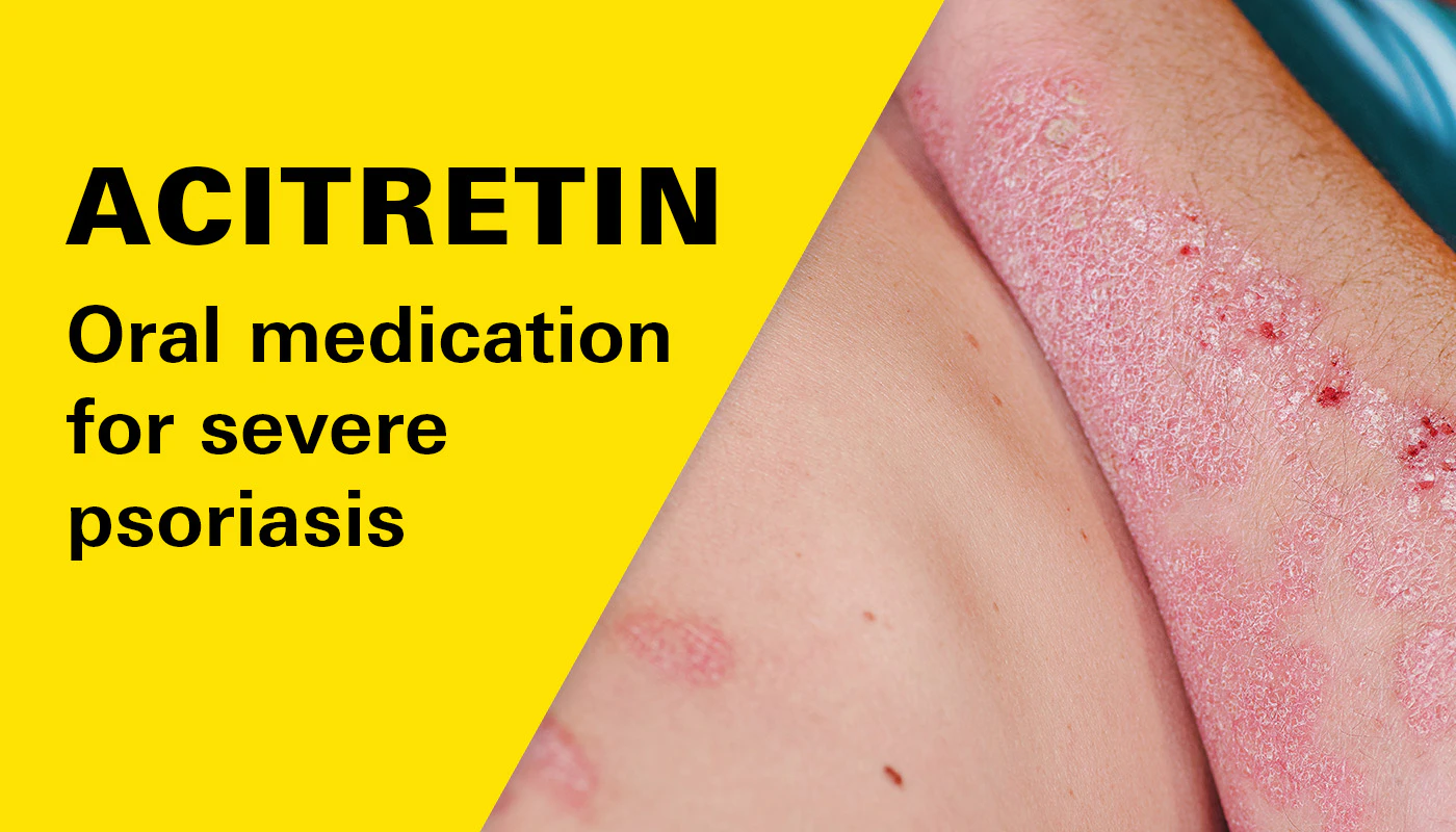 Acitretin for Psoriasis: Is It the Right Treatment for You?