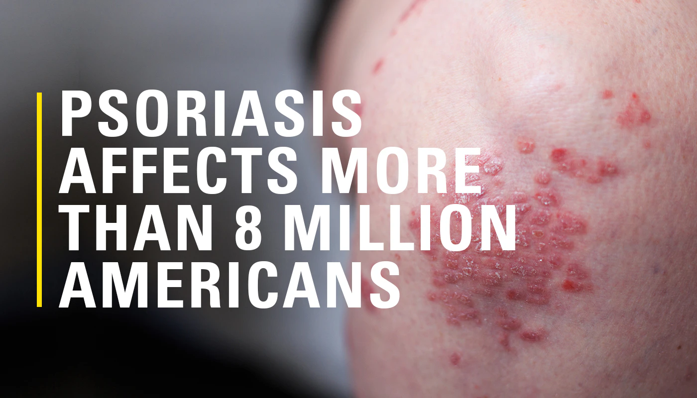 Psoriasis: Causes, Symptoms, Types, Triggers and Risk Factors