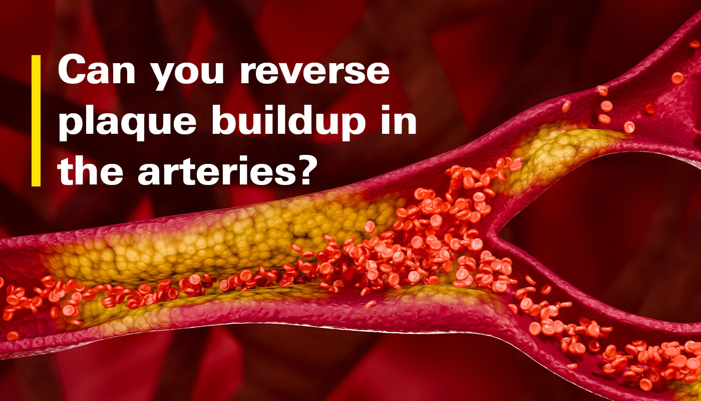 Can you reverse plaque buildup?