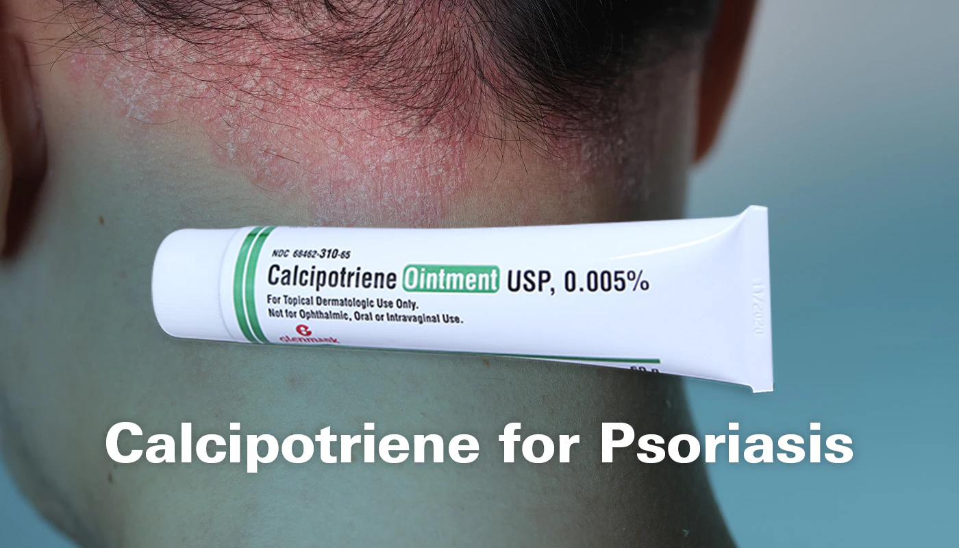 Calcipotriene Ointment for Psoriasis