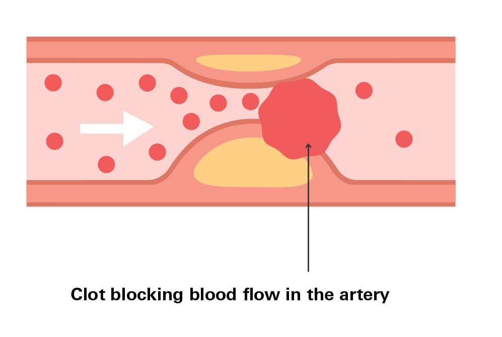 Atherosclerosis: Causes, Risk Factors and Treatments